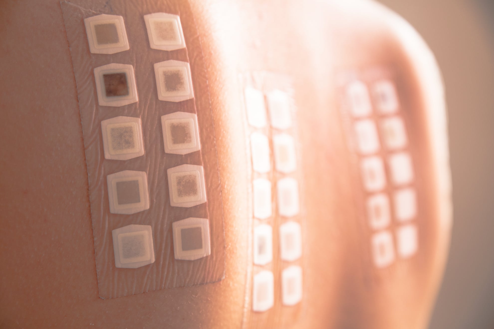 Chronic Rash Treatment 101: Allergy Patch Testing